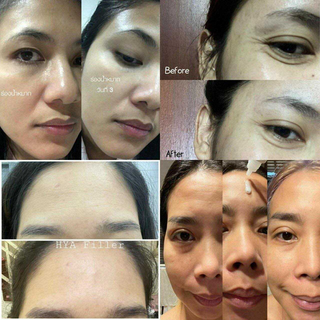 Hya filler ฟิลเลอร์แบบทา 3ขวด 1,200 | LINE SHOPPING