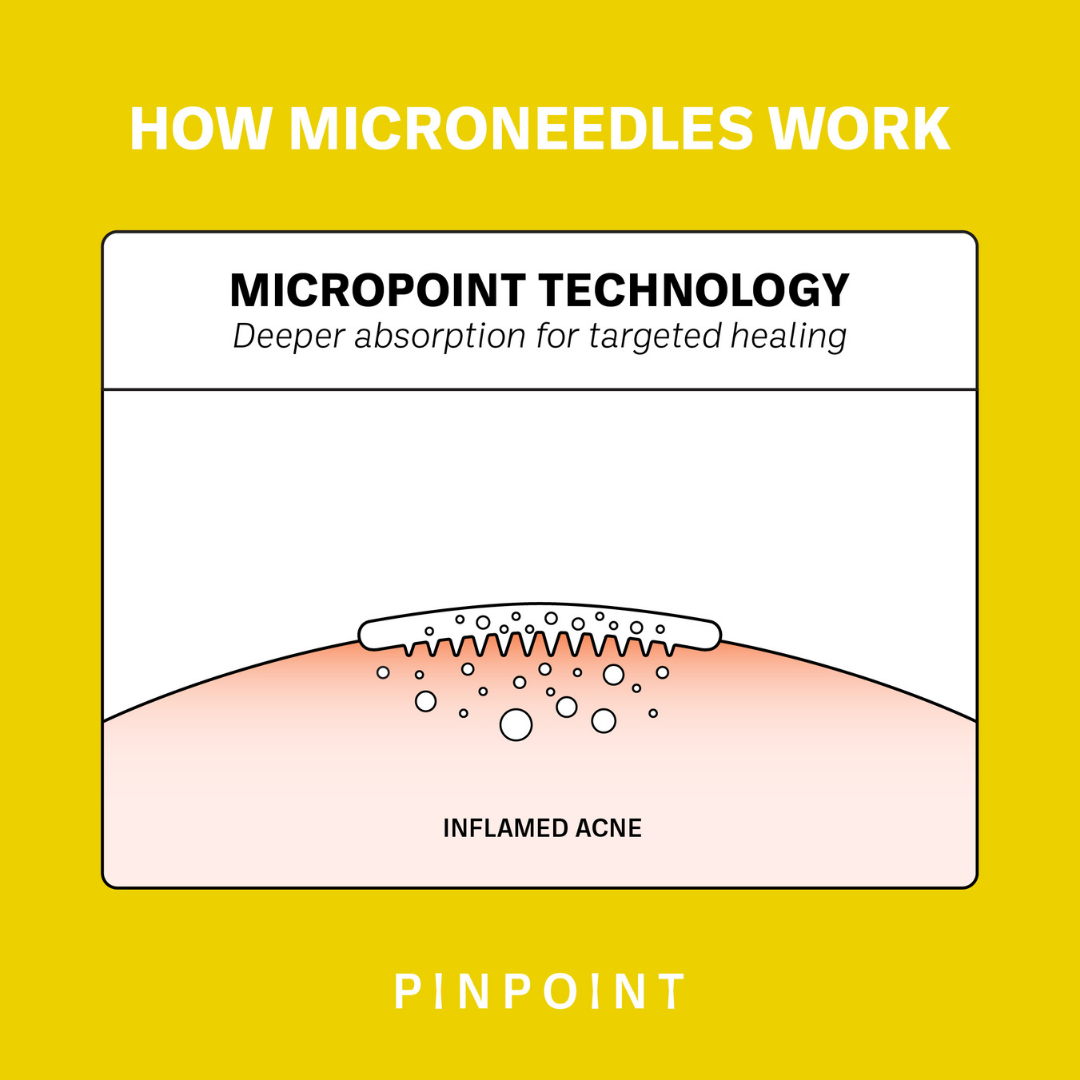PINPOINT [x2 PACK] Acne Rescue Micro Patch แผ่นแปะสิวหัวเข็ม แอคเน่เรส ...